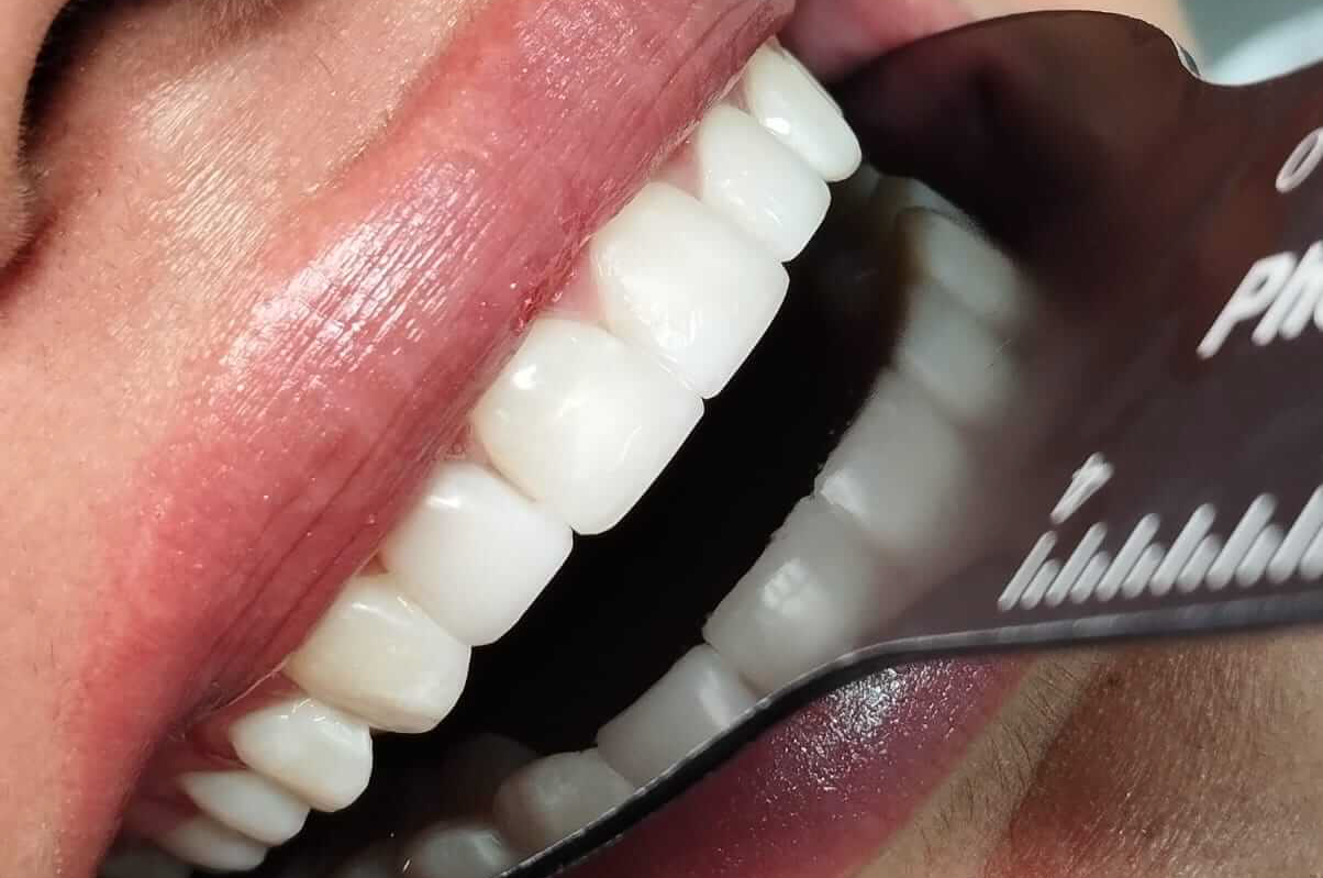 Dental microdesign – Natural Dent